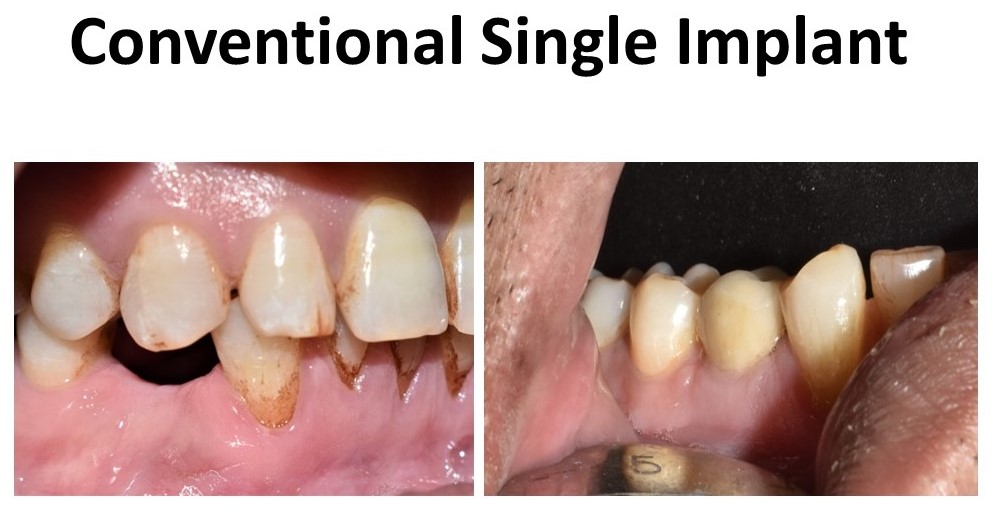 Conventional Single Implant_2